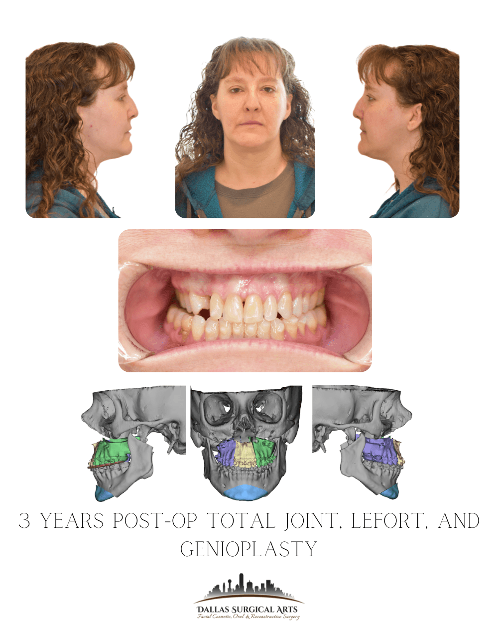 Jaw Repositioning (Orthognathic Surgery) | Dallas Surgical Arts